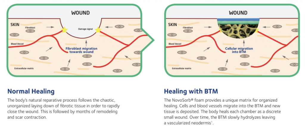 What is NovoSorb® BTM?