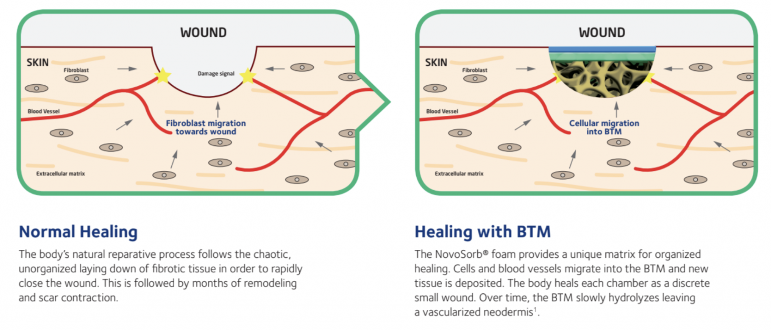 What is NovoSorb® BTM?