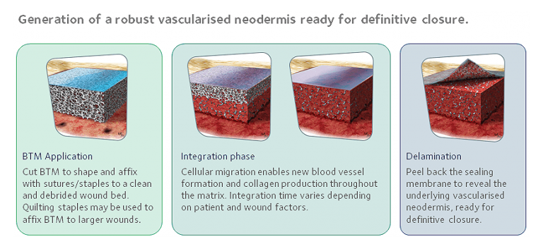 Top 9 Questions about Using NovoSorb BTM in a Clinical Setting - PolyNovo